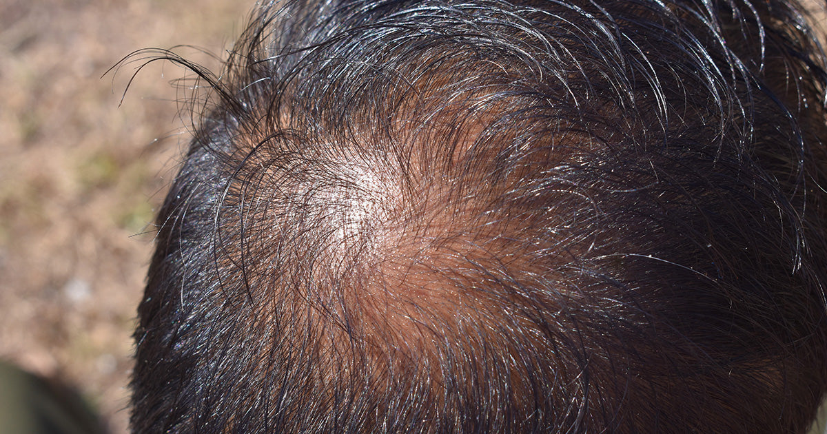 Hair Miniaturization: What it is and How to Stop it - Hairfinity
